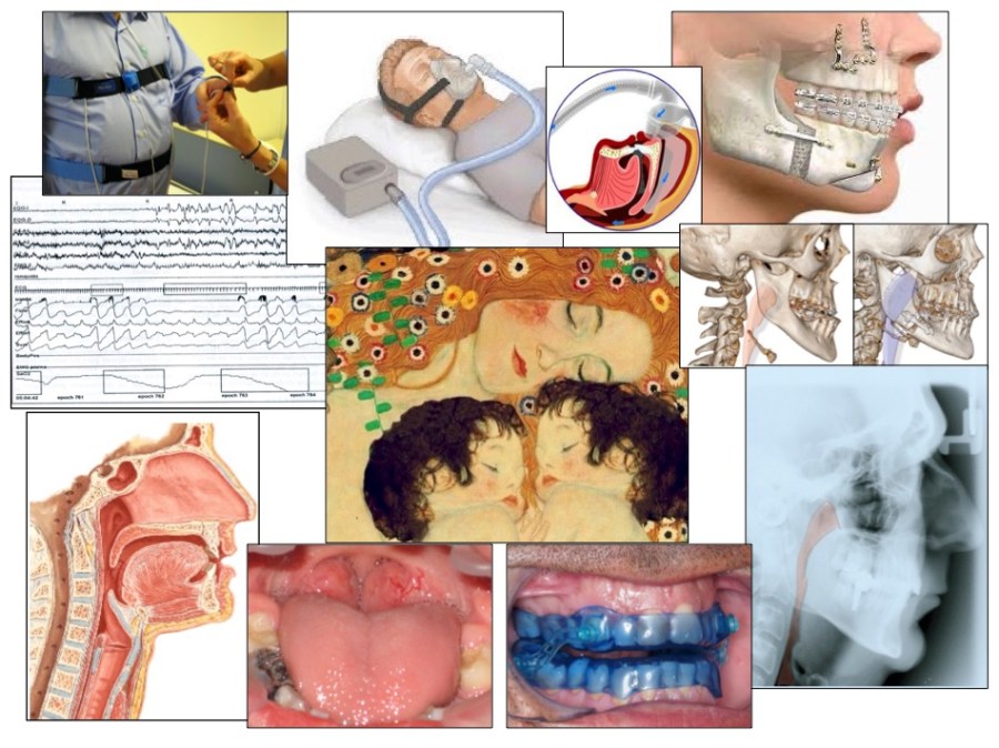 Abordaje Multidisciplinar en el Diagnóstico y Tratamiento de la Apnea ...